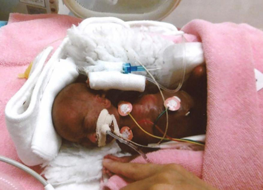 Worlds Smallest Baby Boy Ready to Go Home in Japan