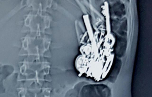Stomach surgery reveals keys, coins, 80 items