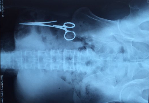Doctors remove Scissors from man’s abdomen after 18 years