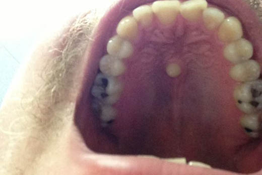 Man with TOOTH growing from the roof of his mouth